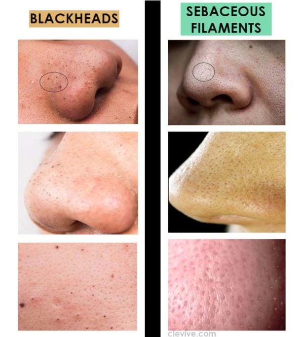 What is the difference between a blackhead & a sebaceous filament – Clevive