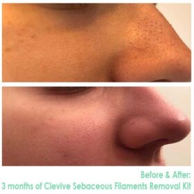 The Sebaceous Filaments Removal Kit – Clevive
