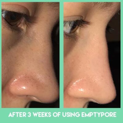 EmptyPore™ Sebaceous Filament Removal Machine – Clevive