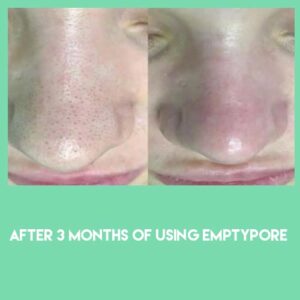 EmptyPore™ Sebaceous Filament Removal Machine – Clevive